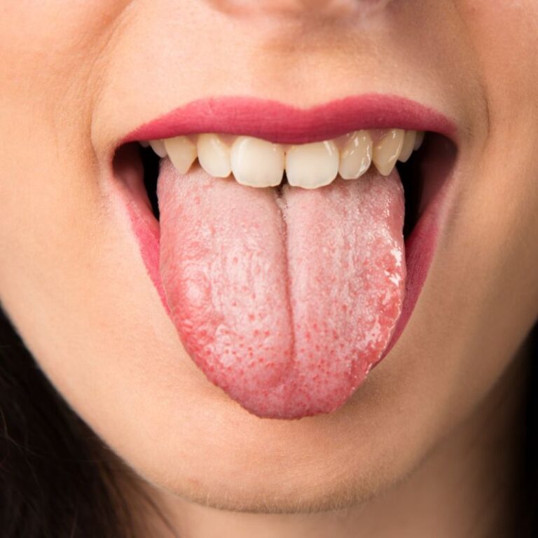 Yeast Infection Symptoms to Watch For - Candida Overgrowth & Gut Health ...