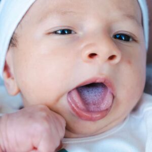 Oral Thrush In Mouth, Causes, Symptoms and Treatment - Candida.com