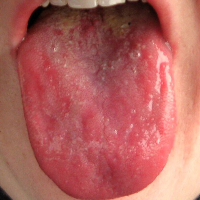 Oral Thrush In Mouth, Causes, Symptoms and Treatment - Candida ...