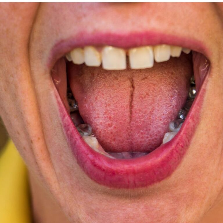 Oral Thrush In Mouth, Causes, Symptoms and Treatment - Candida ...
