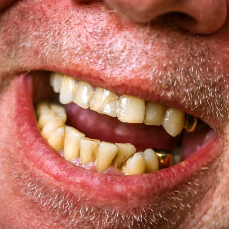 Oral Thrush In Mouth, Causes, Symptoms and Treatment - Candida.com