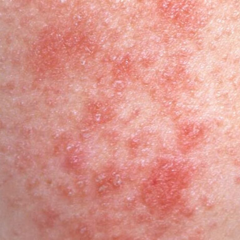 Candida Die Off Symptoms You Should Know - Candida Overgrowth & Gut ...